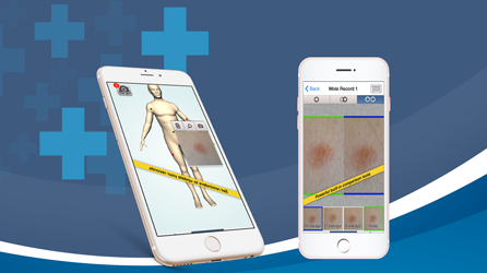 Mole Monitor App | SPEC INDIA